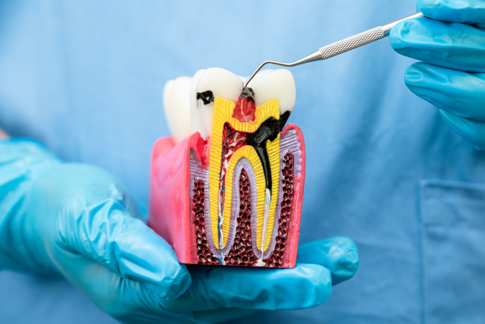 Truth About Root Canals: Do I Need a Root Canal?